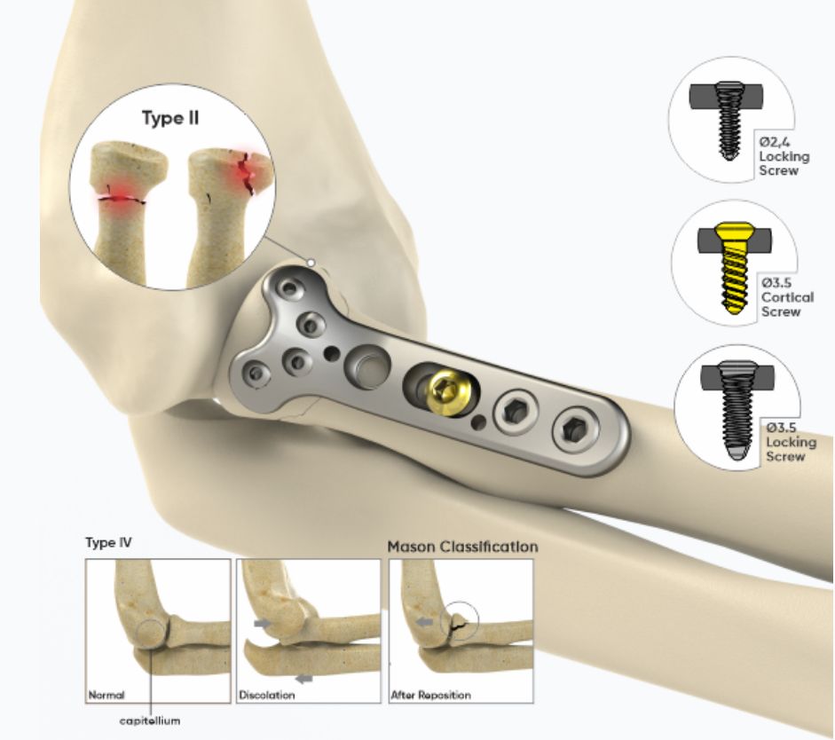 Locking proximal Radial head plates